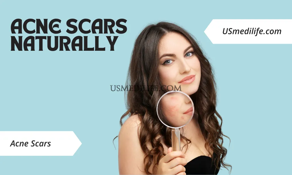 How To Get Rid Of Back Acne Scars Naturally?